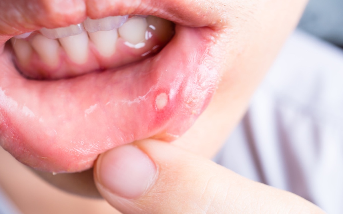What Is Laser Canker Sore Removal And Treatment Alexandria Dental Care What Is Laser Canker Sore Removal And Treatment Alexandria Dental Care